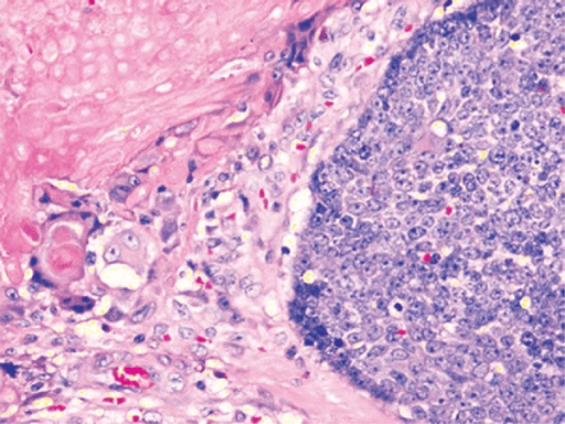 What is a Pilomatricoma? - Pathosomes