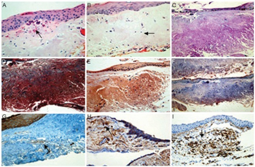 What is Pinguecula? - Pathosomes