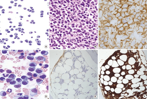 What are Plasma Cell Neoplasms? - Pathosomes
