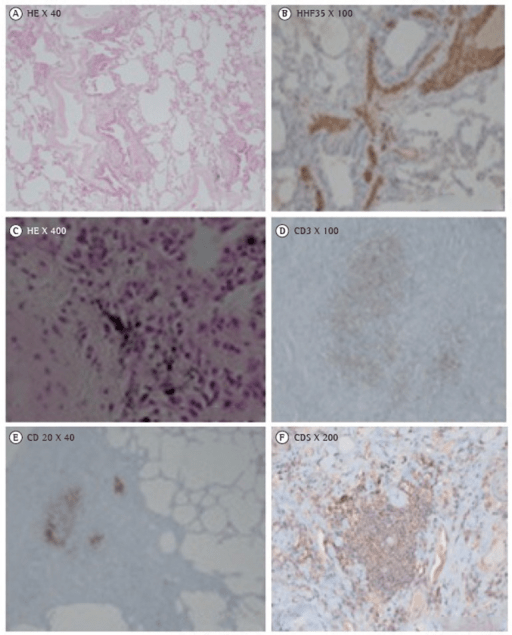 What are Pneumoconioses? - Pathosomes