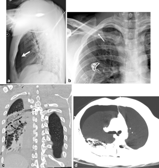 What is a Pneumothorax? - Pathosomes