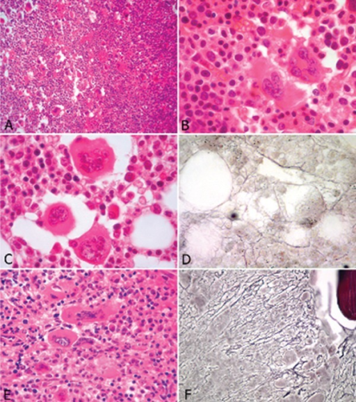 What is Polycythemia Vera? - Pathosomes