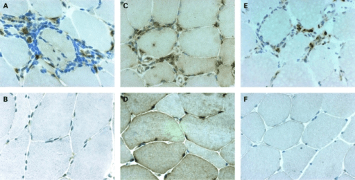 What is Polymyositis? - Pathosomes