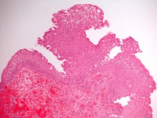 What is Polypoid Cystitis? - Pathosomes