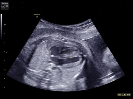 What is Pregestational Diabetes? - Pathosomes