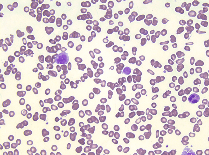 What is Primary Myelofibrosis? - Pathosomes