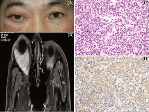 What is Proptosis? - Pathosomes