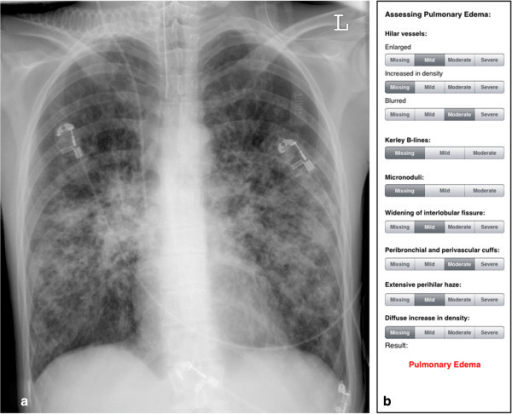 What is Pulmonary Edema? - Pathosomes
