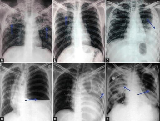 Lung Cancer Pathology Study Guide - Pathosomes