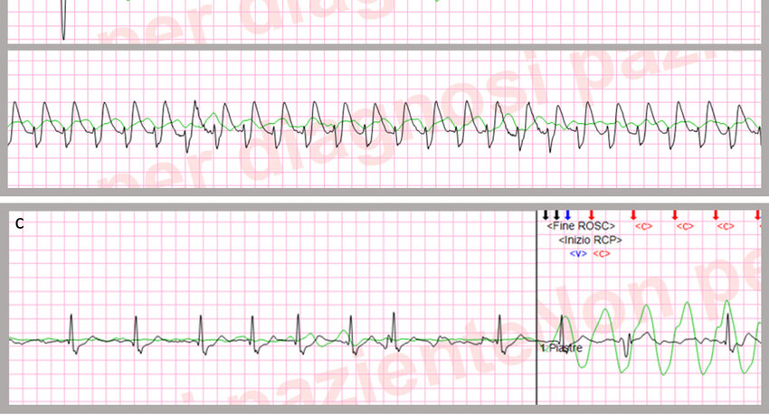 What is Pulseless Electrical Activity? - Pathosomes