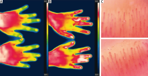What is Raynaud Phenomenon? - Pathosomes