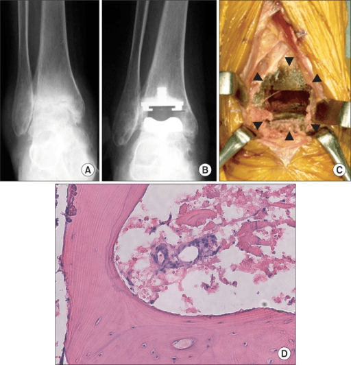 What is Reactive Arthritis? - Pathosomes