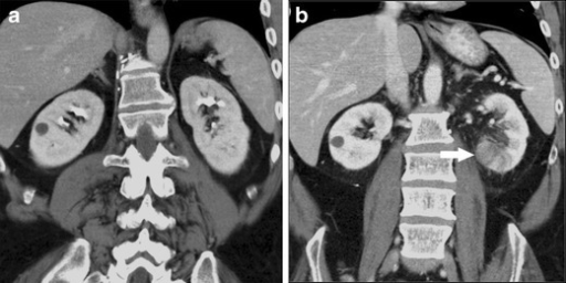 What are Renal Infarcts? - Pathosomes