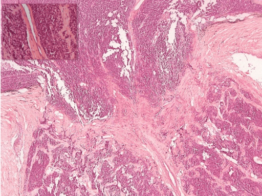What is Retina Pathology? - Pathosomes