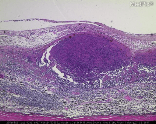 What is Retinal Lymphoma? - Pathosomes