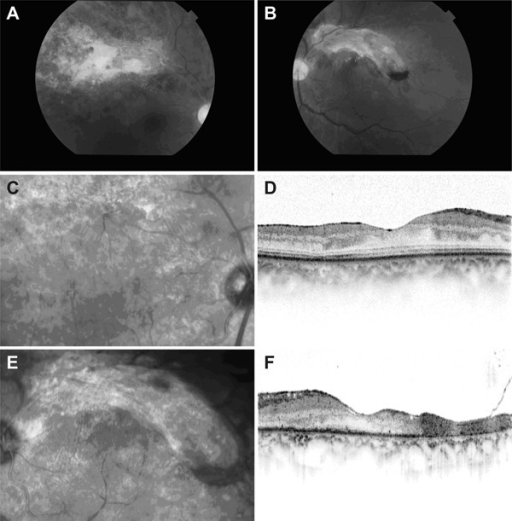 What is Retinitis? - Pathosomes