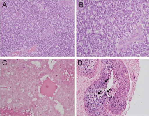 What is Retinoblastoma? - Pathosomes
