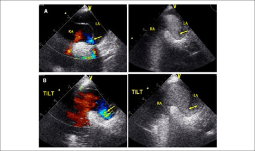 What are Right-to-Left Shunts? - Pathosomes