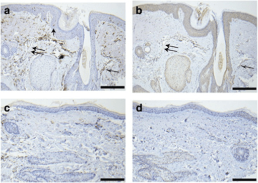 What is Rosacea? - Pathosomes