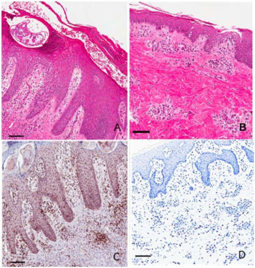 What Is Scabies? - Pathosomes