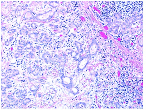 What is Sialadenitis? - Pathosomes