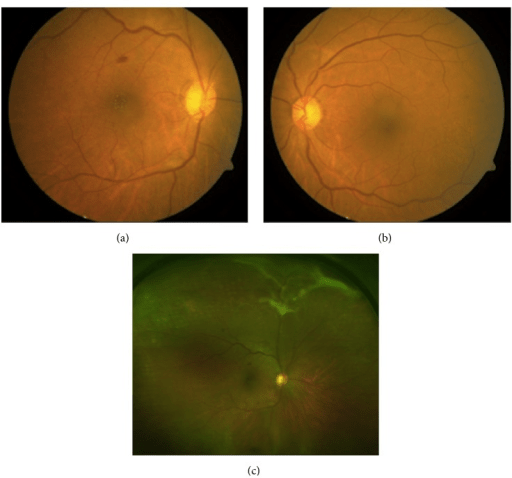 What is Sickle Cell Retinopathy? - Pathosomes