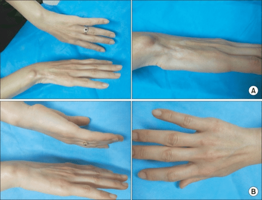 What is Skeletal Muscle Atrophy? - Pathosomes