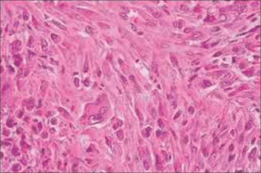What are Smooth Muscle Tumors? - Pathosomes