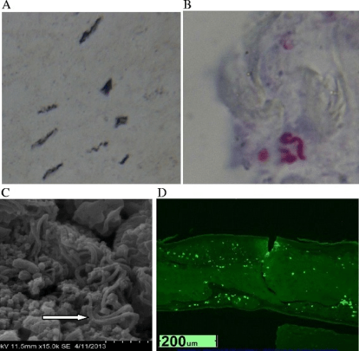 What are Spirochete Bacterial Infections? - Pathosomes