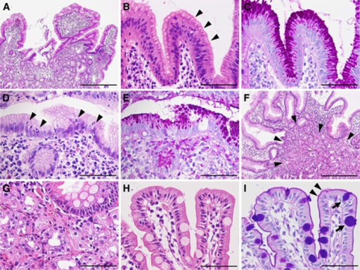 What is Intestinal Metaplasia? - Pathosomes