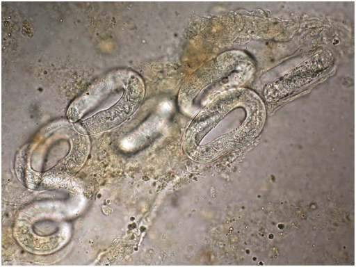 What is Strongyloides Infection? - Pathosomes