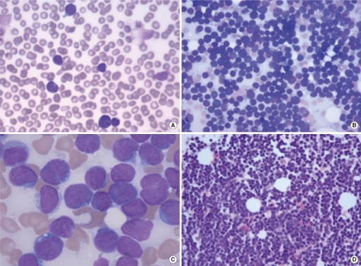 Acute Leukemia Pathology Study Guide - Pathosomes