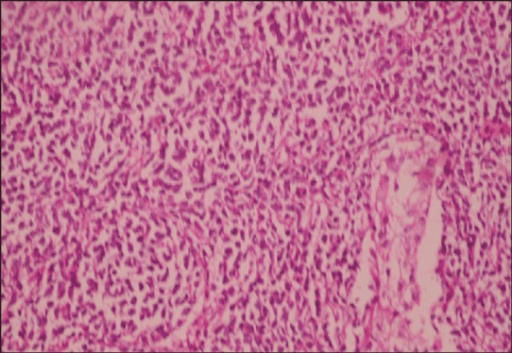 What is Testicular Lymphoma? - Pathosomes