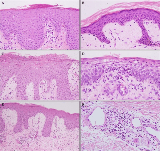 What is Tinea? - Pathosomes