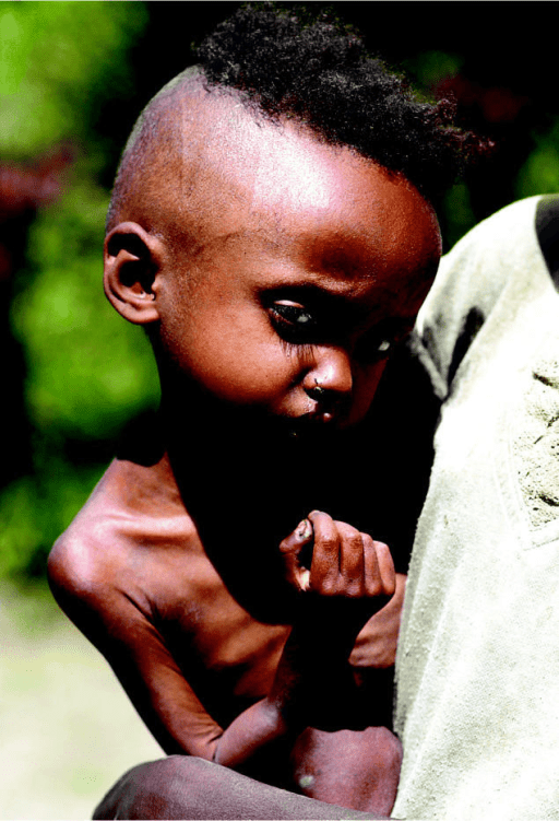 What is Undernutrition? - Pathosomes