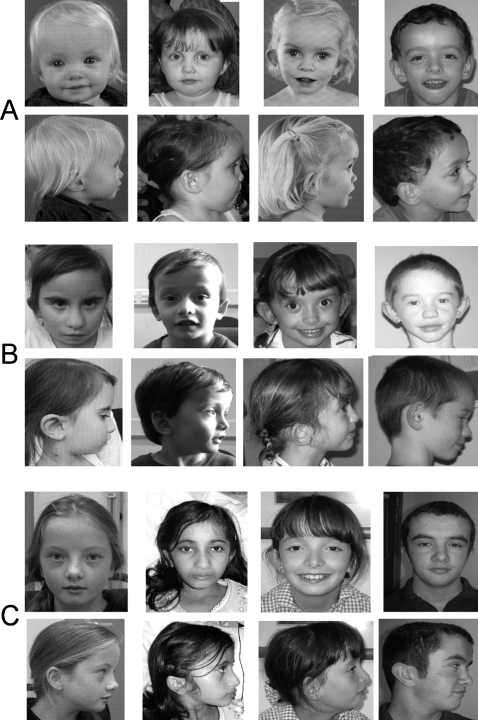 What is Uniparental Disomy? - Pathosomes