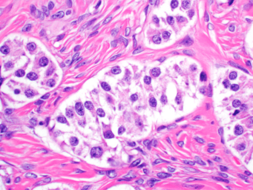 What is a VIPoma? - Pathosomes