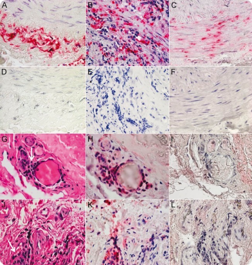 What is Varicella-Zoster Virus Infectious Neuropathy? - Pathosomes