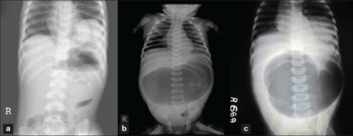 What is Volvulus? - Pathosomes