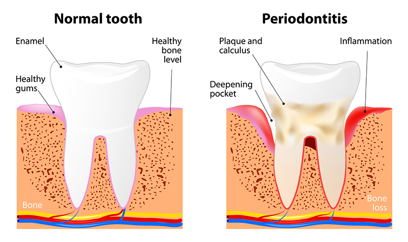 What is Periodontitis? - Pathosomes