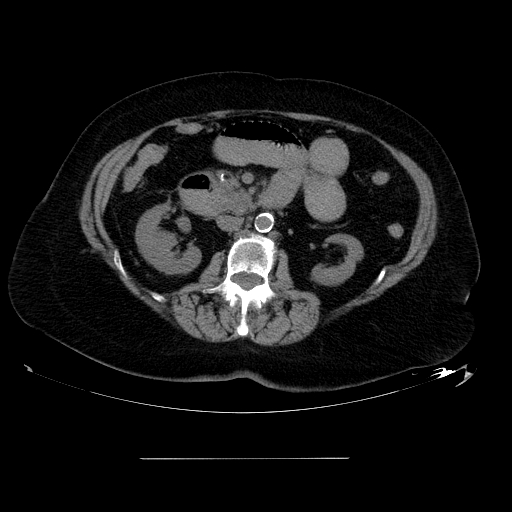 Gallbladder and Biliary Tract Pathology Study Guide - Pathosomes