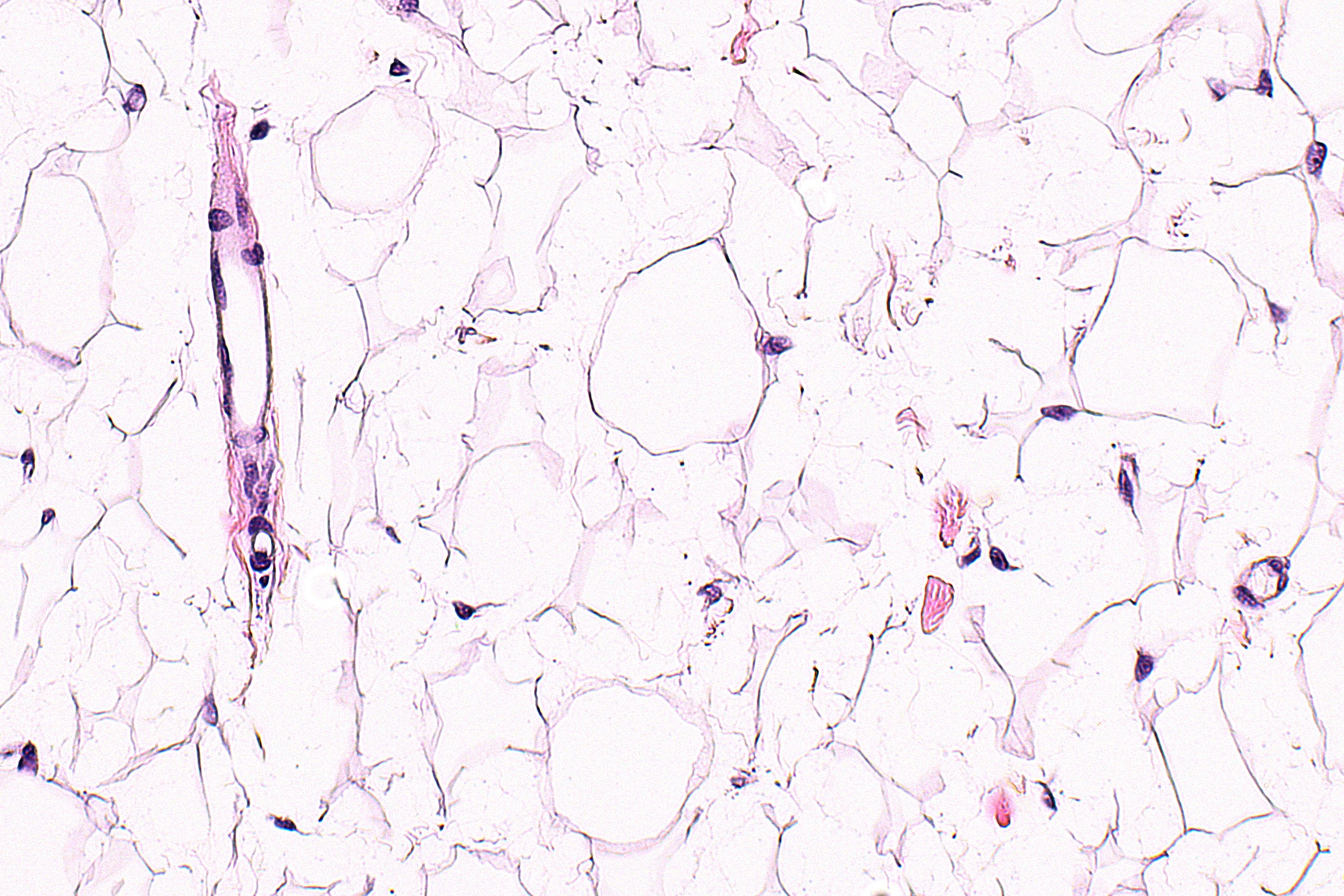 Soft Tissue Tumors Pathology Study Guide - Pathosomes