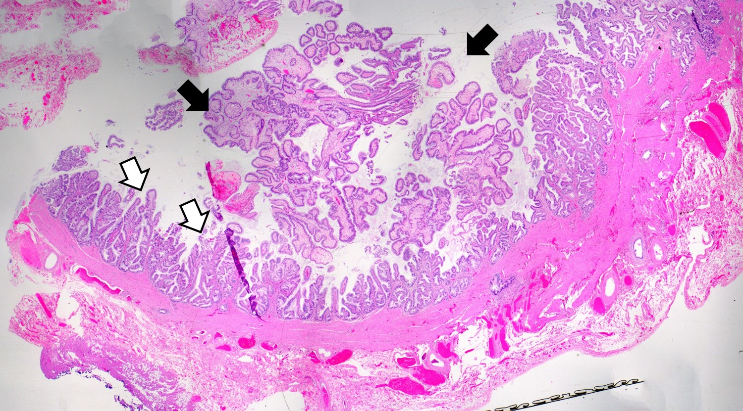 Pancreatobiliary Pathology Society - Welcome to Pancreatobiliary ...