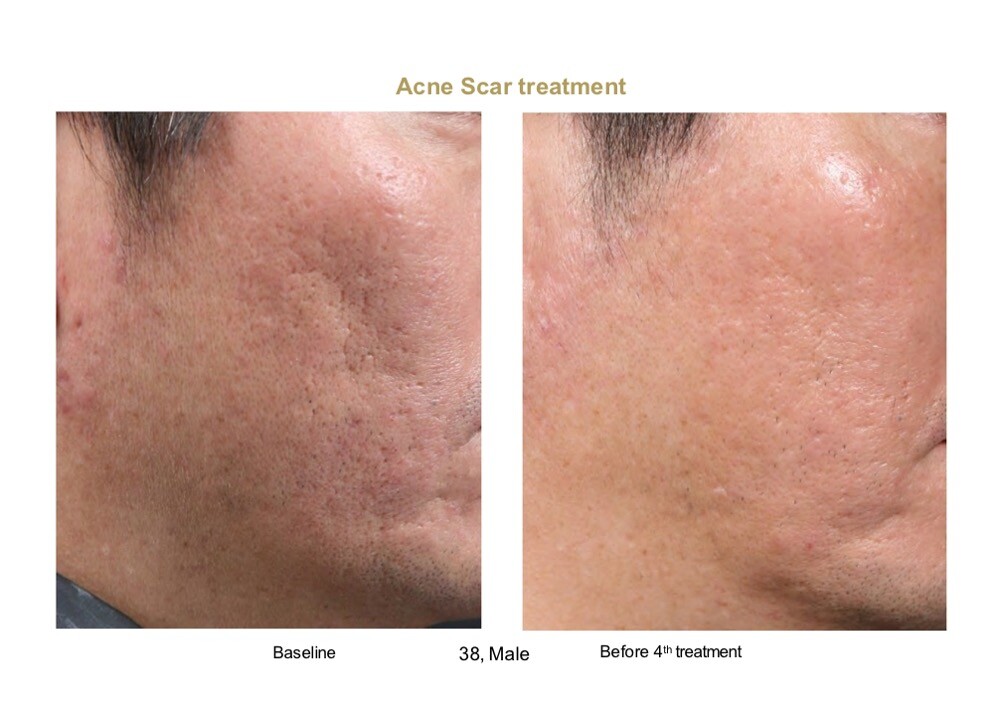 INTRAcel™ Before and After Treatment Images | Perigee Medical