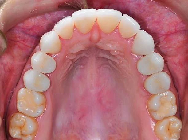 Recommended Ways To Carry Out Posterior Open Bite Treatment | Pestclue