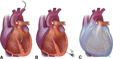 Calcium Cycling (ATPase Pump) in Cardiac Gene Therapy: Inhalable Gene ...
