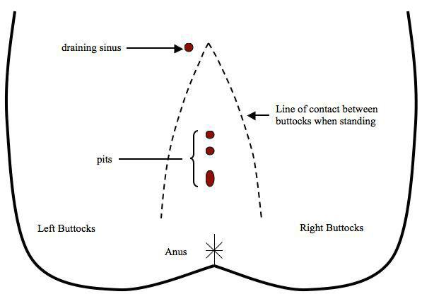 Why Is a Pilonidal Cyst Not Really a Cyst? - Sternberg Clinic