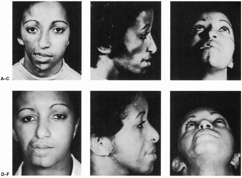 Galeal Flaps | Plastic Surgery Key