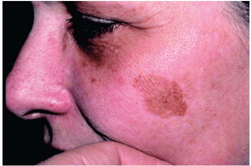 Lentigo | Plastic Surgery Key