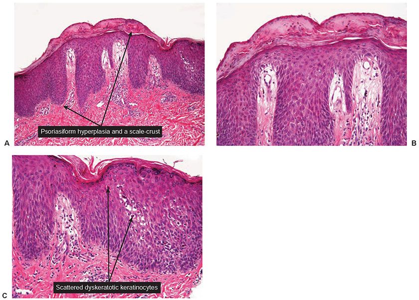 Cutaneous Manifestations of Nutritional Deficiency States and ...